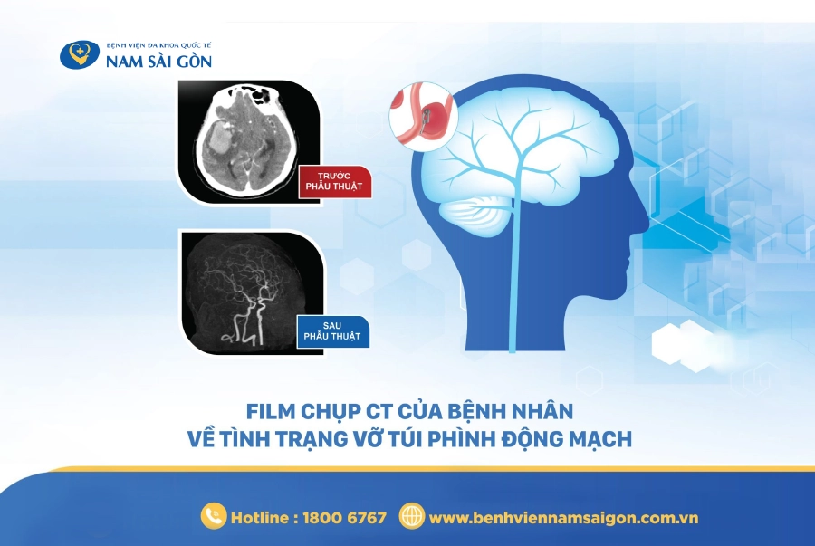 Kịp thời gỡ “quả bom” đột quỵ do vỡ túi phình động mạch não