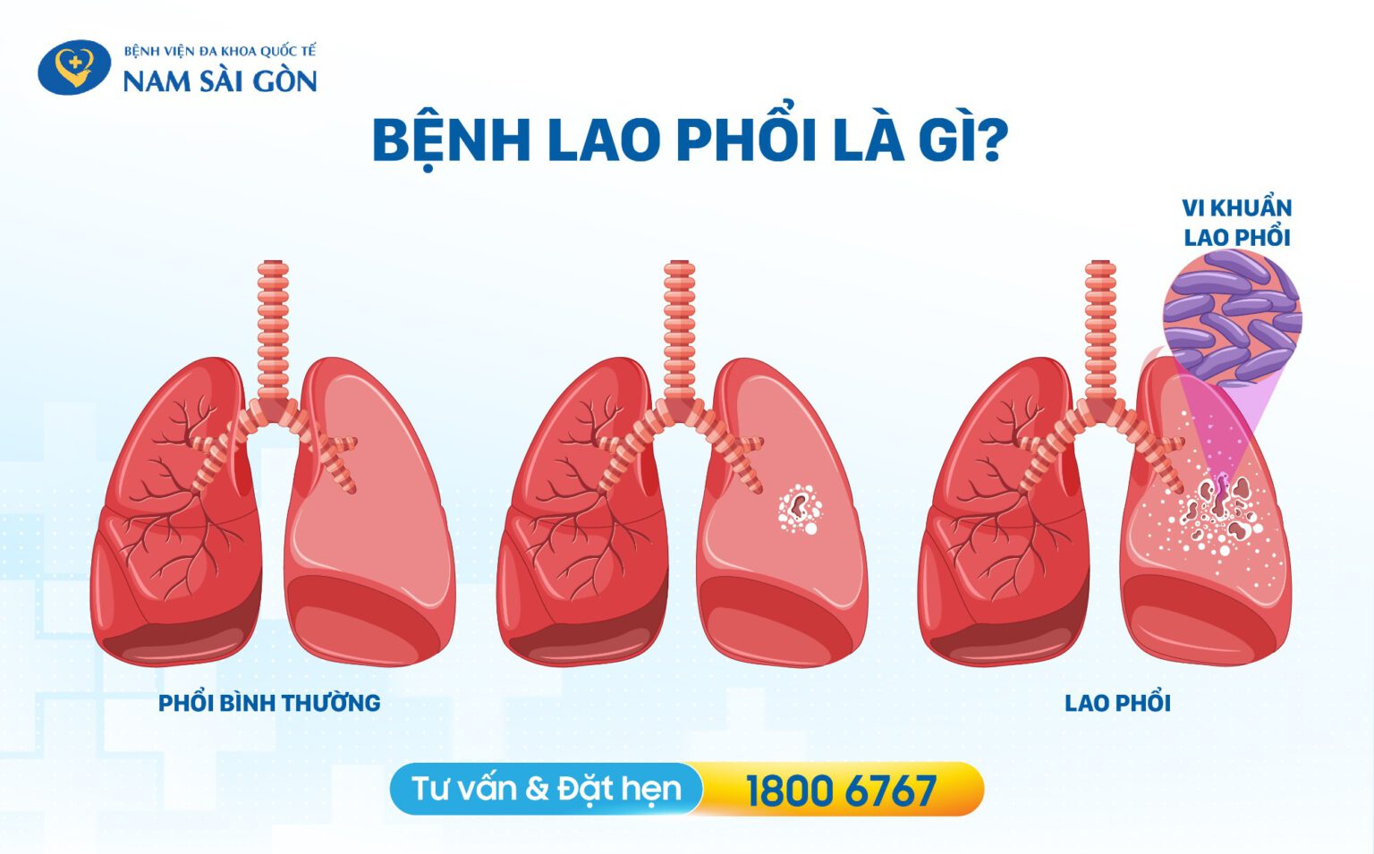 Bệnh lao phổi – Nguyên nhân, triệu chứng và cách điều trị